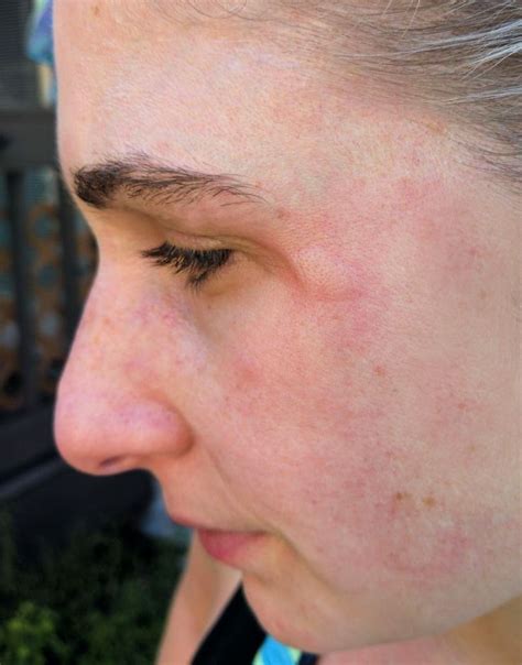 Hypothyroidism Skin Rash