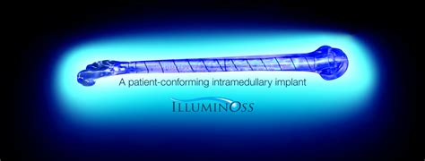 Illuminoss Medical Inc On Linkedin Distal Femur Fracture Revised With