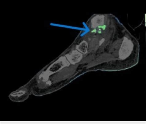 Dect Of The Right Foot Demonstrating Uric Acid Deposition Most