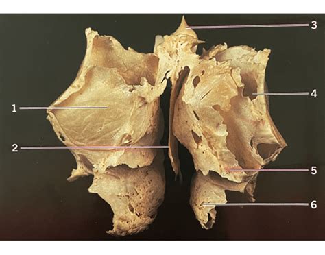 Ethmoid Posterior View Quiz