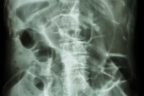 Traitement Naturel De Locclusion Intestinale Remèdes Et Prévention Icm46