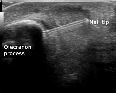 Bursitis Olecrani Mrt Pacs