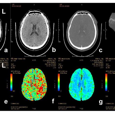 Ct And Ctp Imaging Of The Patient With Acute Ischemic Stroke The Download Scientific Diagram