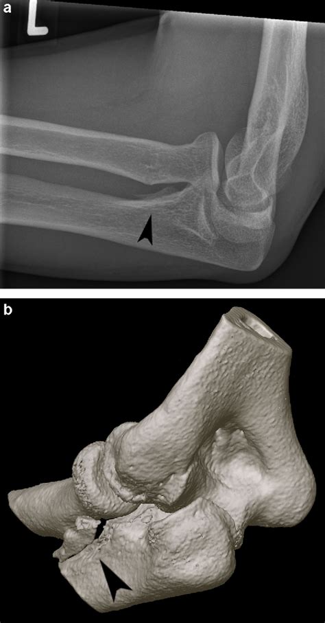 Figure 1 From Avulsion Fracture Of The Supinator Crest As An Indication For A Sustained