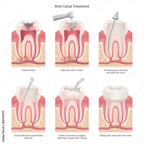 Root Canal Treatment Tooth Canal Rooth Filling Endodontic Procedure Roots Bacteria Infection