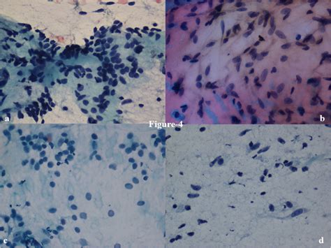 Fibroadenoma Versus Phyllodes Tumor A Vexing Problem Revisited Pmc