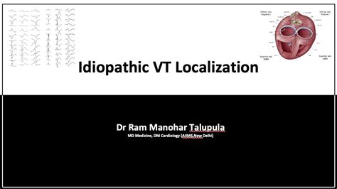 Idiopathic Vpc Localisation On Ecg Manohar Cardiology Youtube