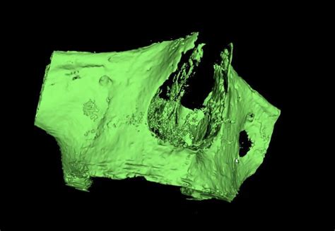 Three Dimensional Model Created On Invesalius Software Download
