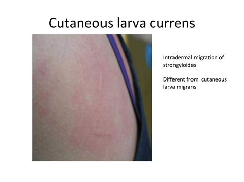 Intestinal Nematodes Ppt