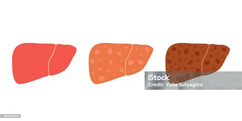 간 장기 단계 손상 건강 지방간 섬유증 간경변 간 질환 벡터 간 내부 기관에 대한 스톡 벡터 아트 및 기타 이미지 간 내부 기관 간암 간염 Istock