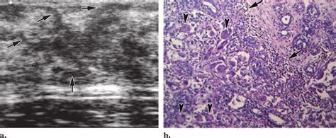 Granulomatous Mastitis In A 35 Year Old Woman After Pregnancy A Us