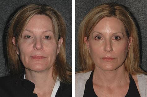 Vertical Facelift Best Vertical Facelift In New York