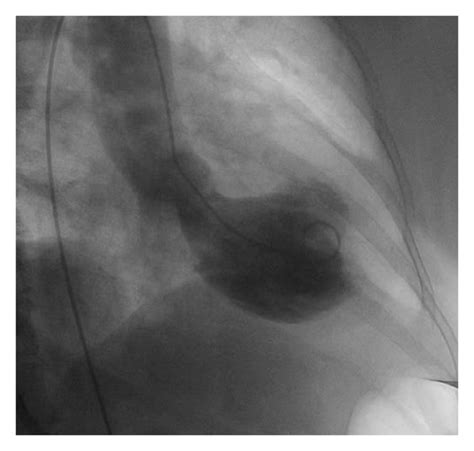 Left Ventriculogram Showing Apical And Basal Hyperkinesis And Mid Download Scientific Diagram