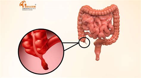 Appendicitis Appendicitis Treatment Diet In Appendicitis Types Of Appendicitis