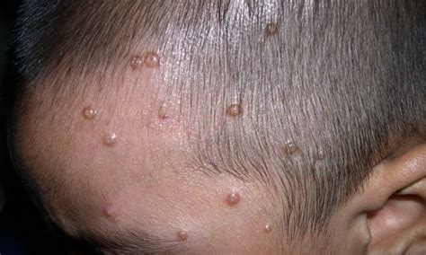 Контагиозный моллюск причины возникновения симптомы и способы лечения Miratalk
