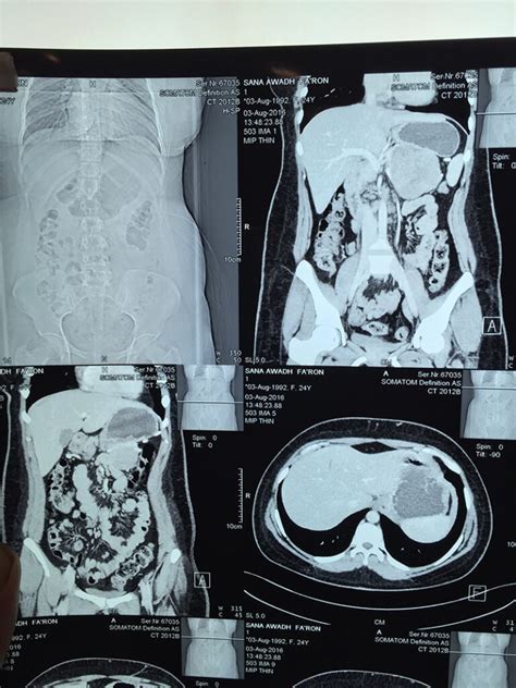 Distal Pancreatectomy And Splenectomy For Pancreatic Body And Tail Tumour Dr Raad Al Saffar