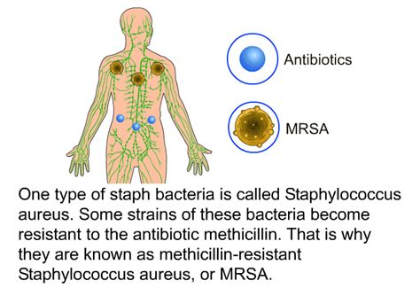 Preventing Mrsa Infections Community