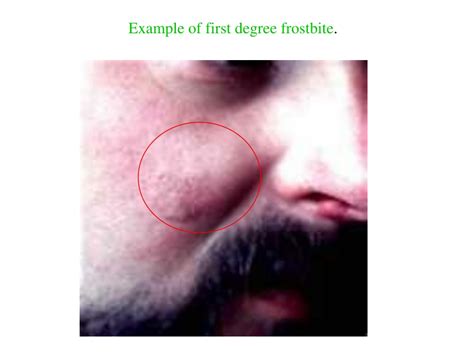 Ppt Wind Chillfrostbite Chart Powerpoint Presentation Free Download