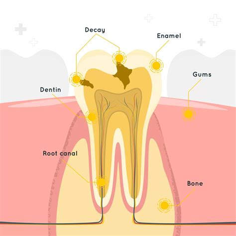 Root Canal Tooth Decay
