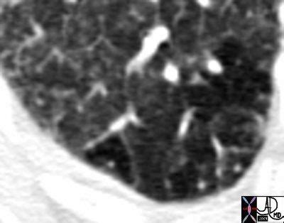 Faces Of Mosaic Attenuation Lungs