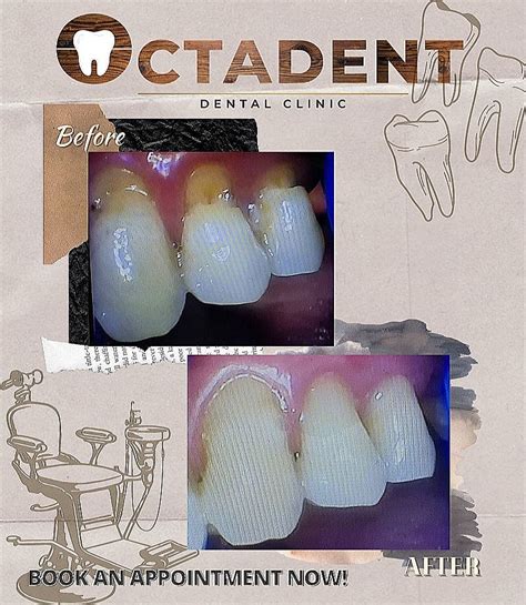 Octadent Dental Clinic Bacolod Class V Composite Restorations Class