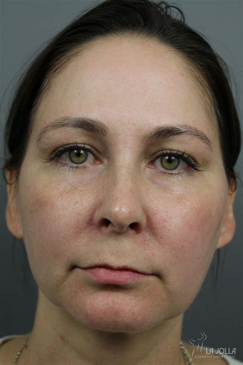 Liquid Facelift Before After Gallery Patient