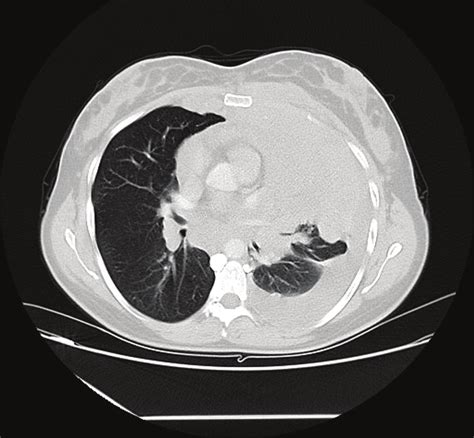 Computerized Tomography Scan At The Time Of Diagnosis Download