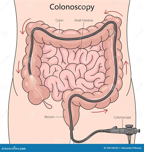 Colonoscopy Procedure Diagram Medical Science Stock Vector Illustration Of Labeled Endoscopy