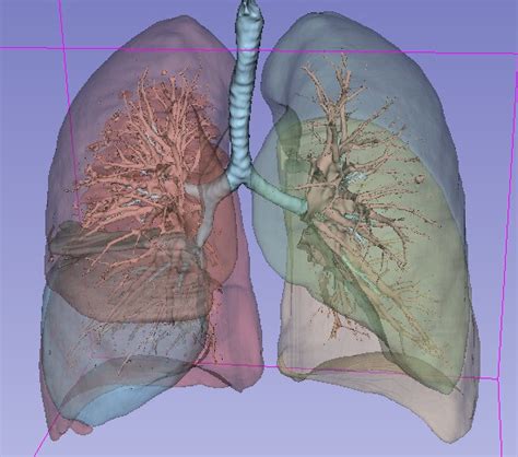 Using Monai Label To Fine Tune The Vessel Segmentation Support 3d