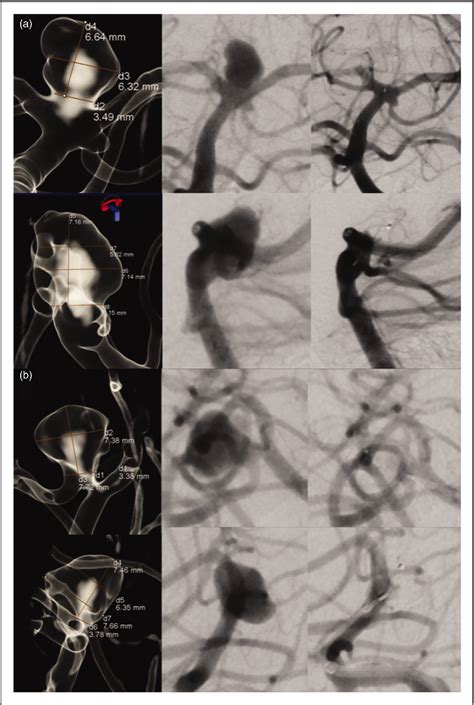 Figure 1 From Semi Automated Cerebral Aneurysm Segmentation And