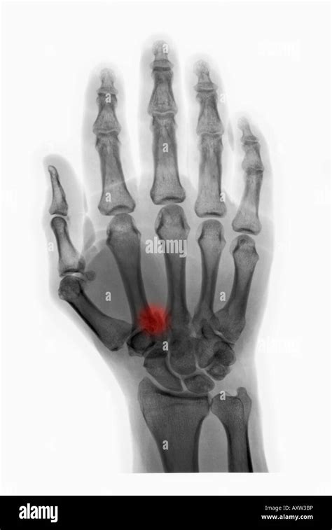 1st Metacarpal