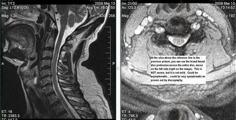 My C Spine Acting Up Again Discography Results ISPINE ORG Forum