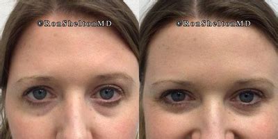 Daxxify Before After Pictures RealSelf