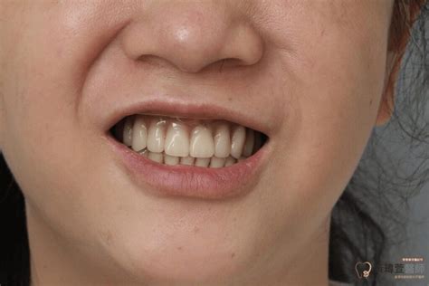 All On 4 全口重建案例 杜小姐 新尊榮黃瑋萱醫師 台北松山牙醫推薦｜全口重建、植牙、全瓷冠、陶瓷貼片