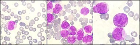 Atypical Promyelocytes In Aml M3 Variant