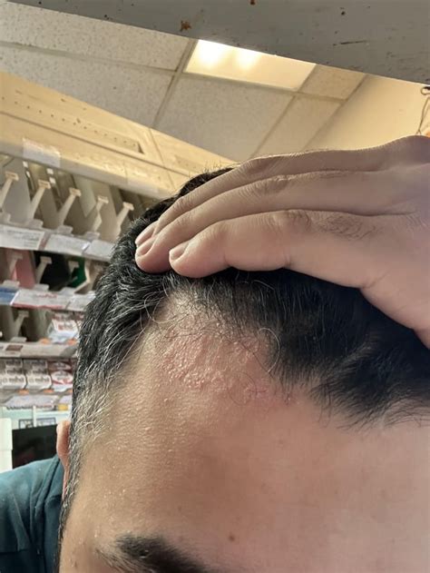 My Scalp Psoriasis Is Gone R Psoriasis