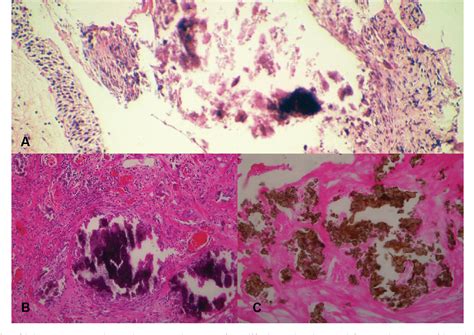Figure 2 From Calcifying Nanoparticles Associated Encrusted Urinary Bladder Cystitis Semantic