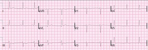 Subtle Lateral St Elevation False Positive This Diagnosis Is Hard Dr Smiths Ecg Blog