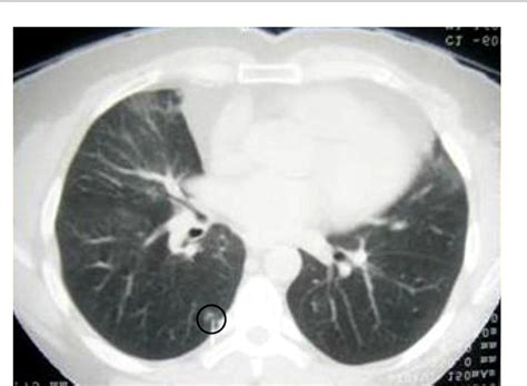 Figure 1 From Locating Pulmonary Nodules With A Computed Axial Tomography Guided Harpoon Prior