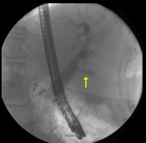 Erc In Patient 1 Showing Mild Dilatation Of Extrahepatic Biliary Tree