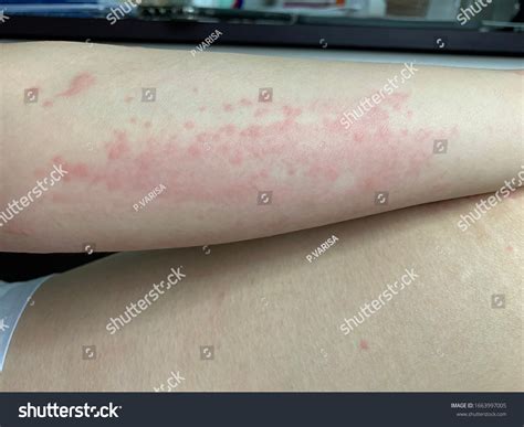 Erythematous Rash