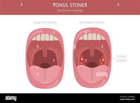 Tonsil Stones Diseases Otorhinolaryngology Chronic Caseous