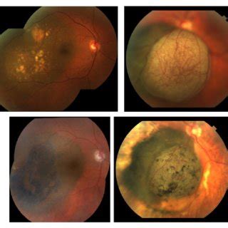 Pdf Regression Patterns Of Choroidal Melanoma After Palladium 103