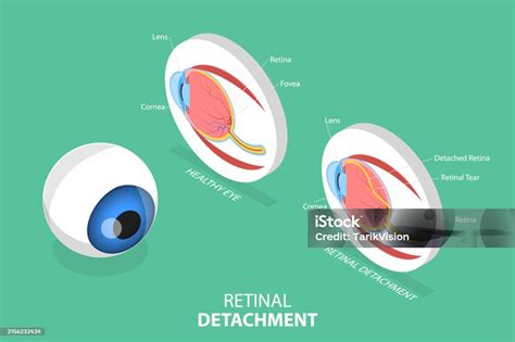 망막 박리의 3d 등각 투영 평면 벡터 개념 그림 3차원 형태에 대한 스톡 벡터 아트 및 기타 이미지 3차원 형태 각막 개념 Istock