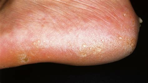 Punctate Keratosis