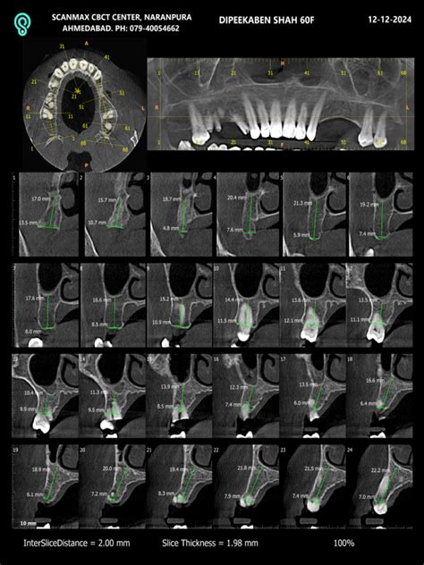 Dipeekaben Shah 60f Cbct Maxilla Pdf