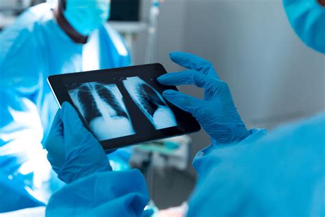 Lung Cancer Wedge Resection For Early Stage Lung Conditions