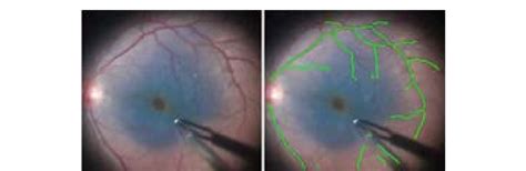 Retinal Vessel Segmentation During Surgery 3 Download Scientific Diagram