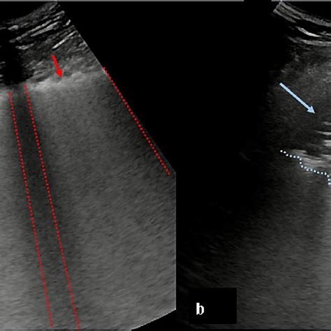 A Red Arrows Indicate Areas Of Interstitial Syndrome Interstitial Download Scientific Diagram