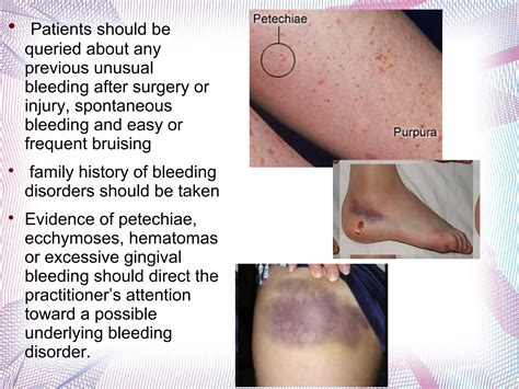 Dental Management Of Hemophiliac Patients Ppt